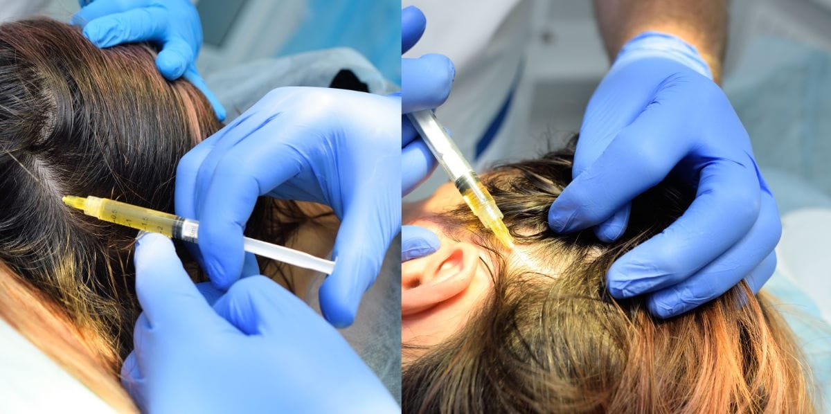 PRP with Biotin Injection for Hair Loss